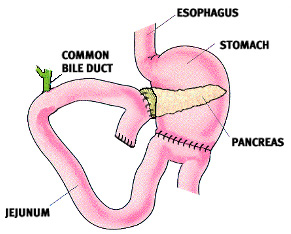 Whipple Procedure Roux Y